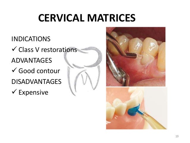 Matrixing and wedges