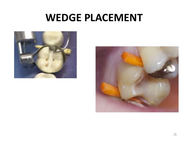 Matrixing and wedges