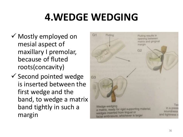 Matrixing and wedges