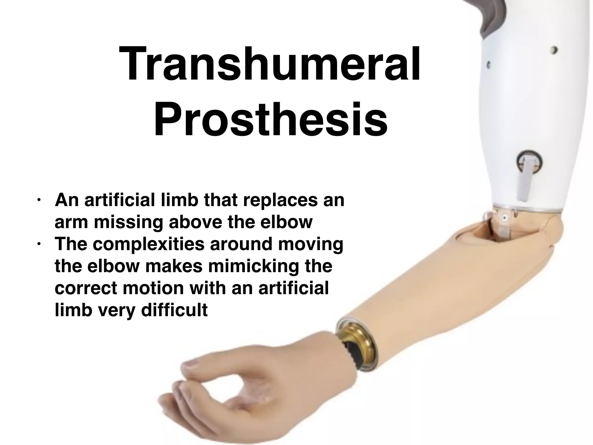 Four Main Types of Artificial Limbs, by Matthew Garibaldi | PPT
