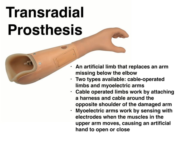Four Main Types of Artificial Limbs, by Matthew Garibaldi | PPT