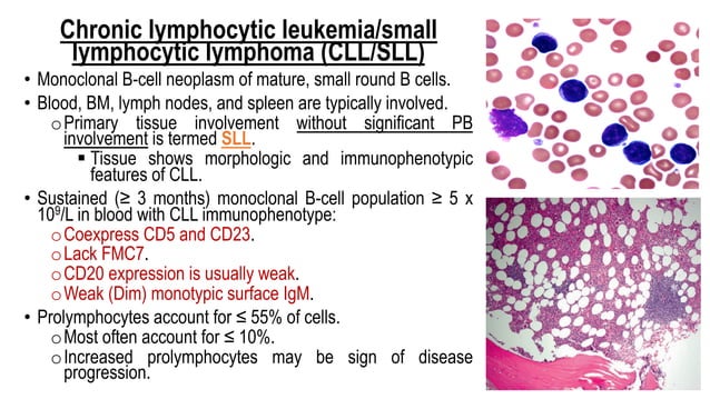 Mature B-cell Neoplasms | PDF