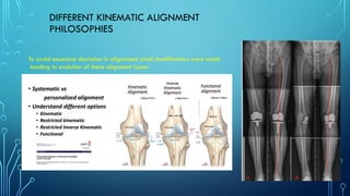 Mechanical Alignment vs Kinematic Alignment vs PA .pptx