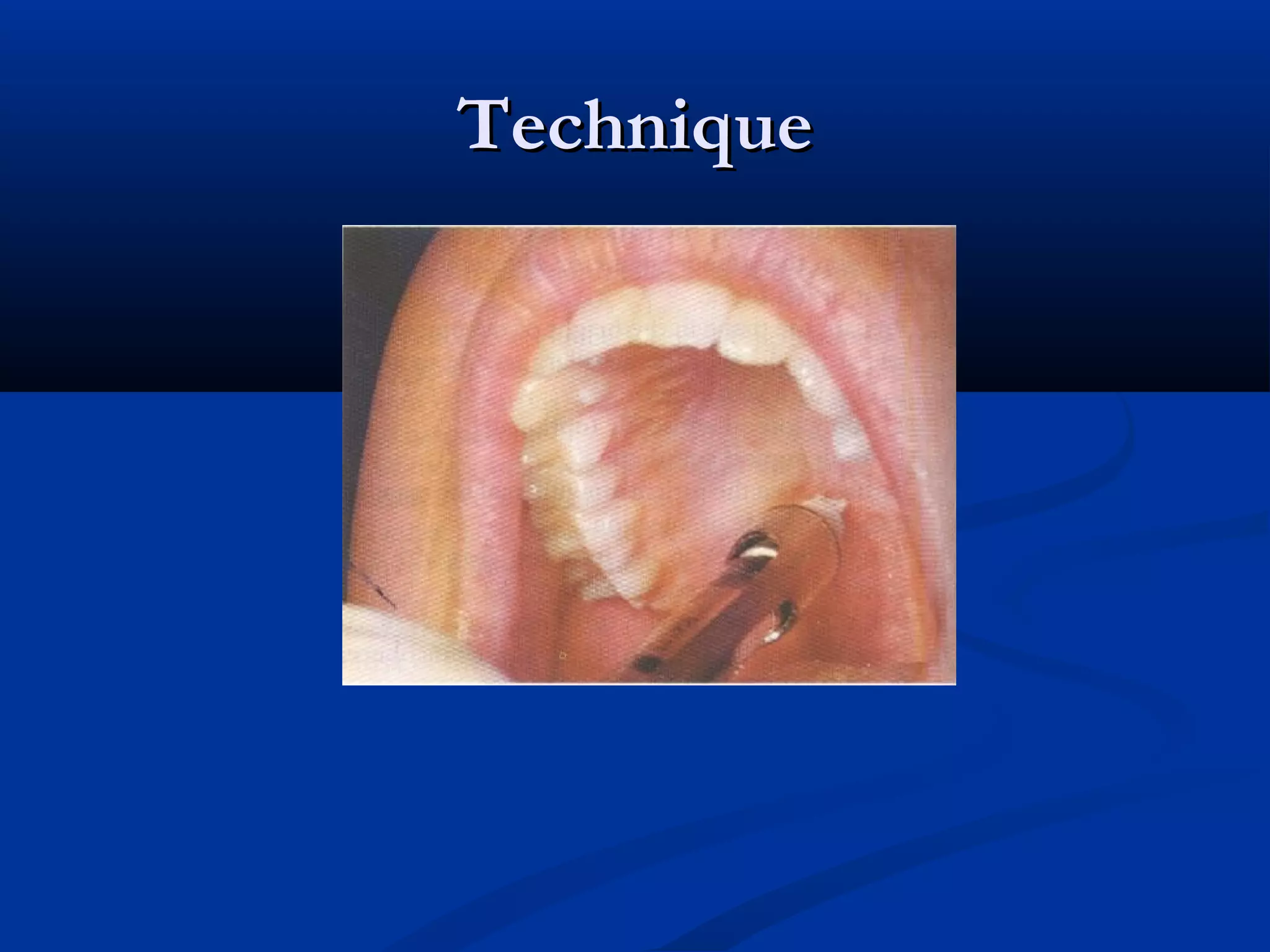 Maxillary Injection Technique | PPT