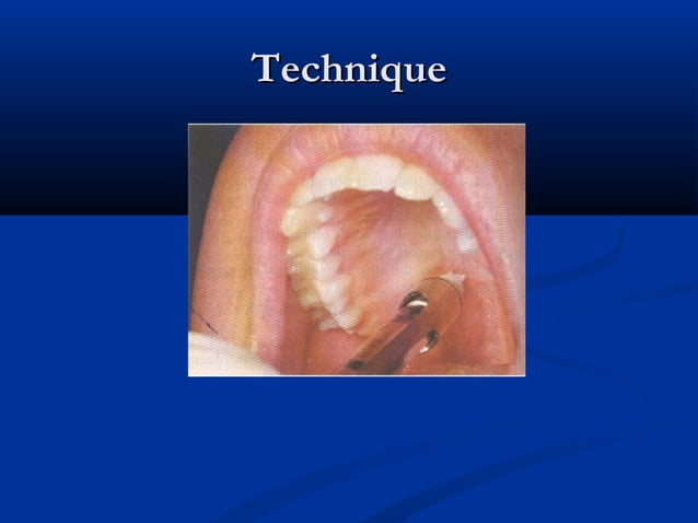Maxillary Injection Technique | PPT