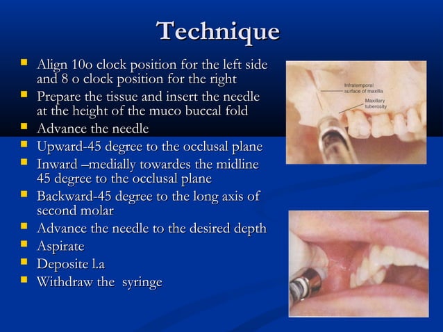 Maxillary Injection Technique | PPT
