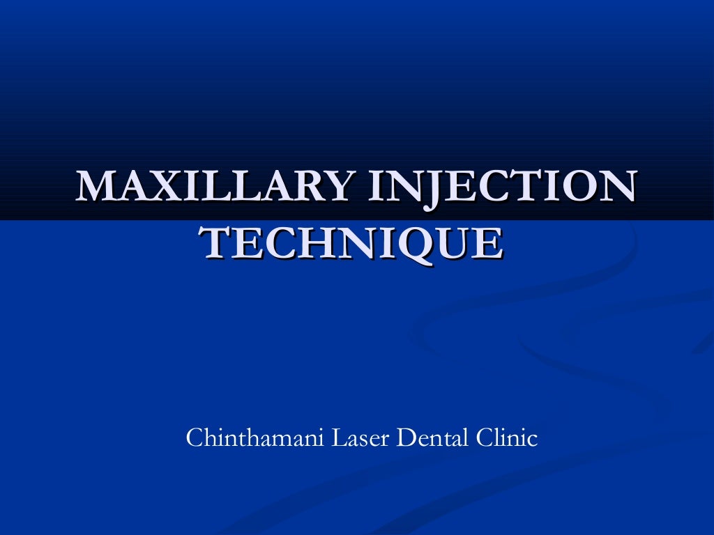 Maxillary Injection Technique