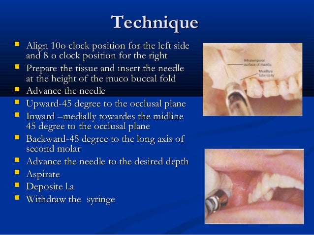 Maxillary Injection Technique