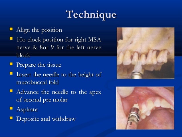 Maxillary Injection Technique