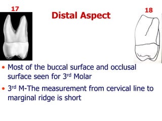 Max 2nd & 3rd molars.ppt