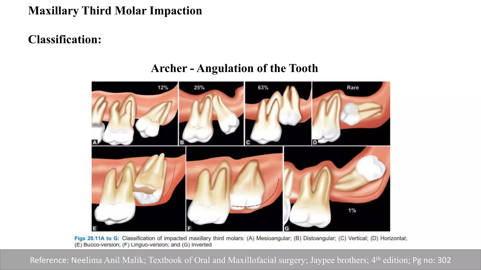 Maxillary canine and molar impaction | PPTX
