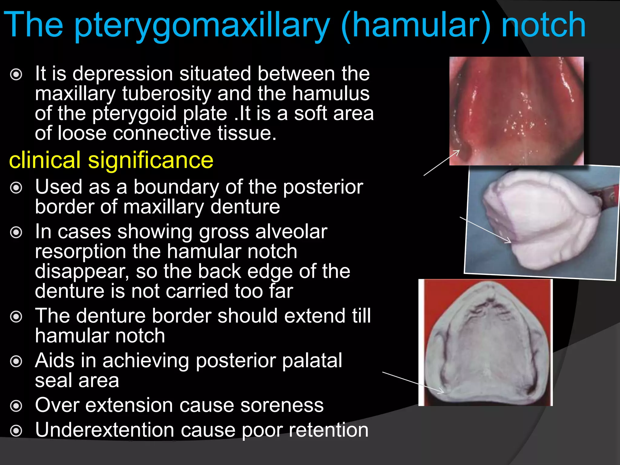 significance of maxillary denture bearing area | PPTX