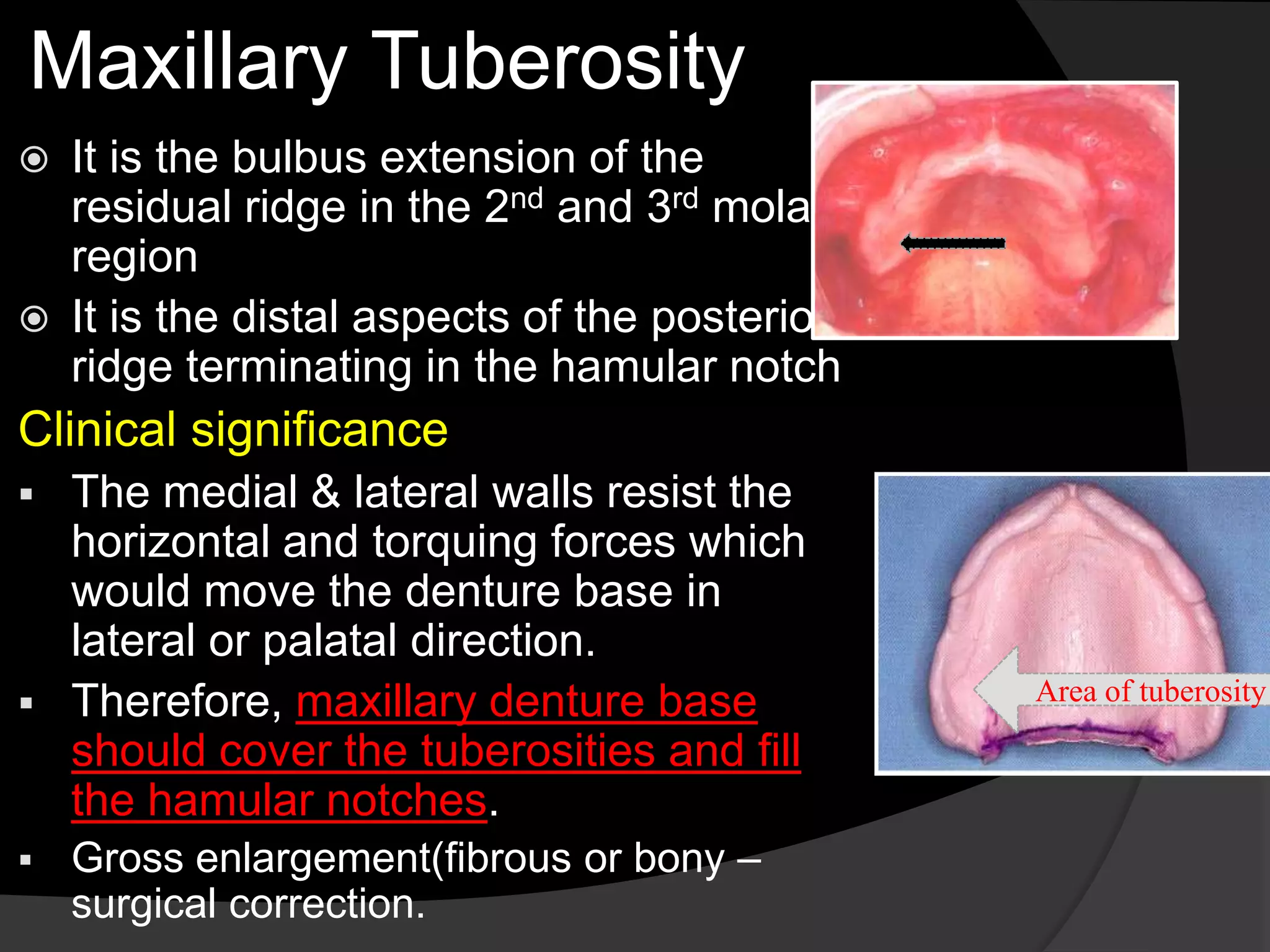 significance of maxillary denture bearing area | PPTX