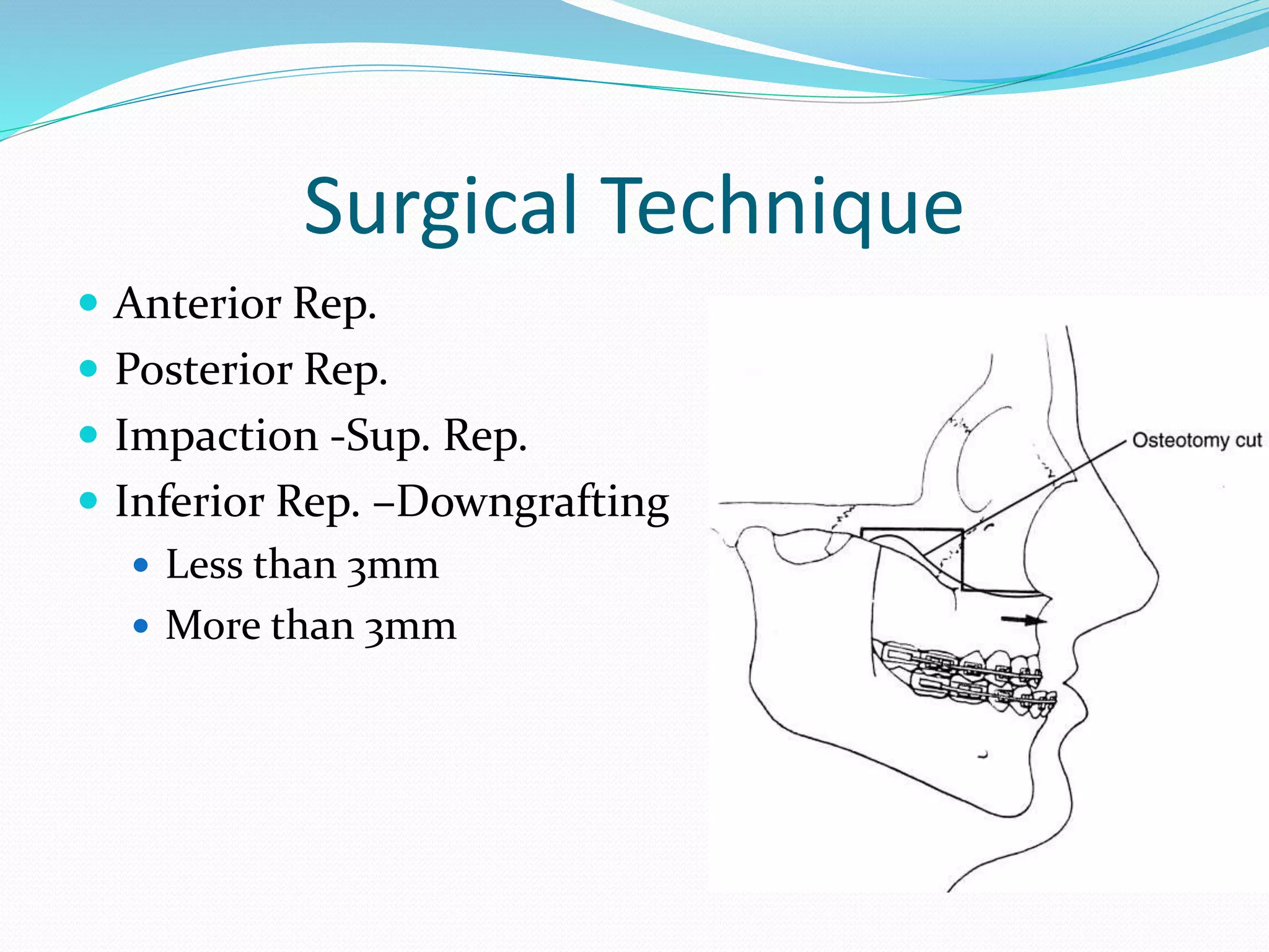 Maxillary surgery | PPT