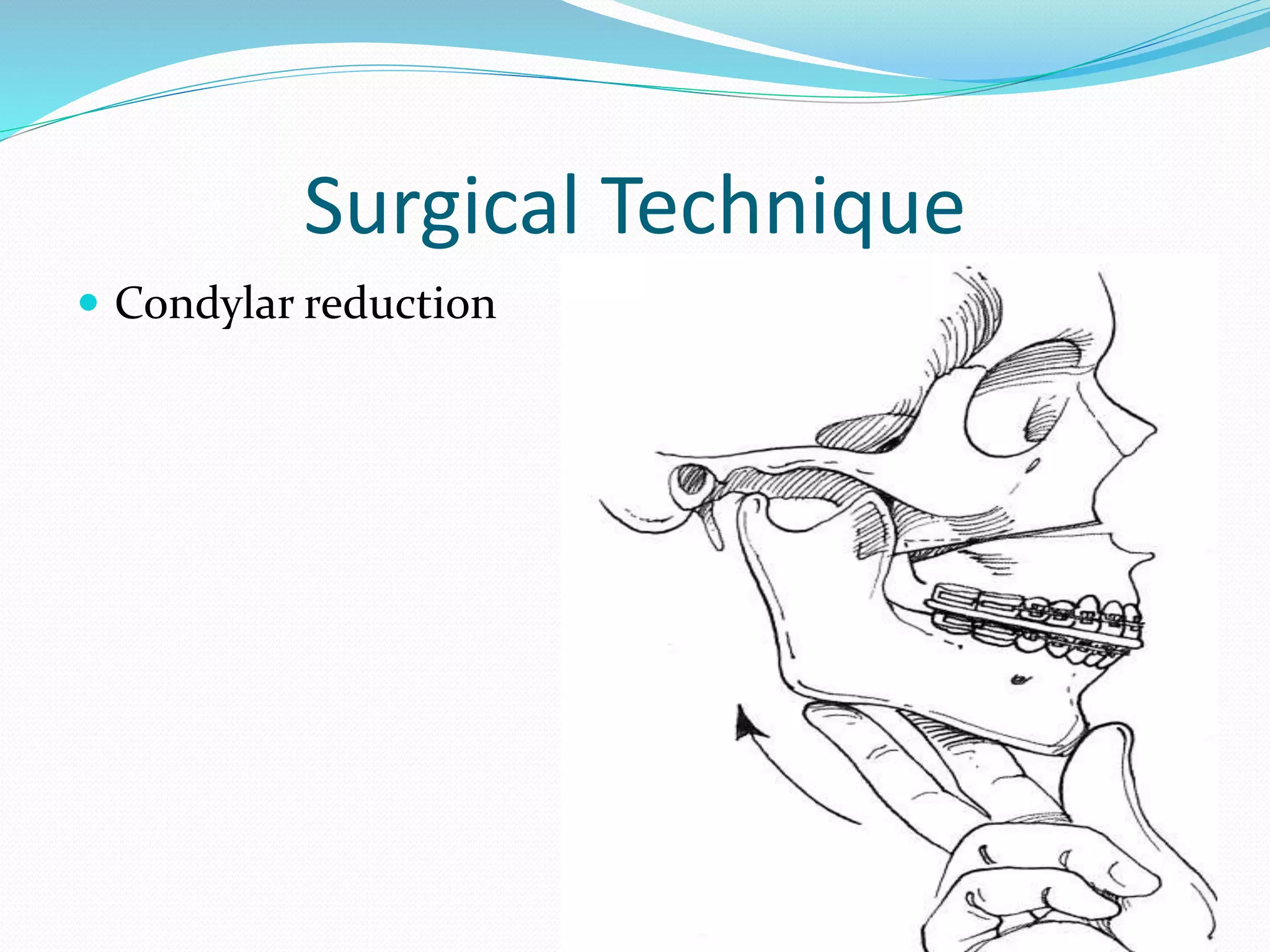 Maxillary surgery | PPT