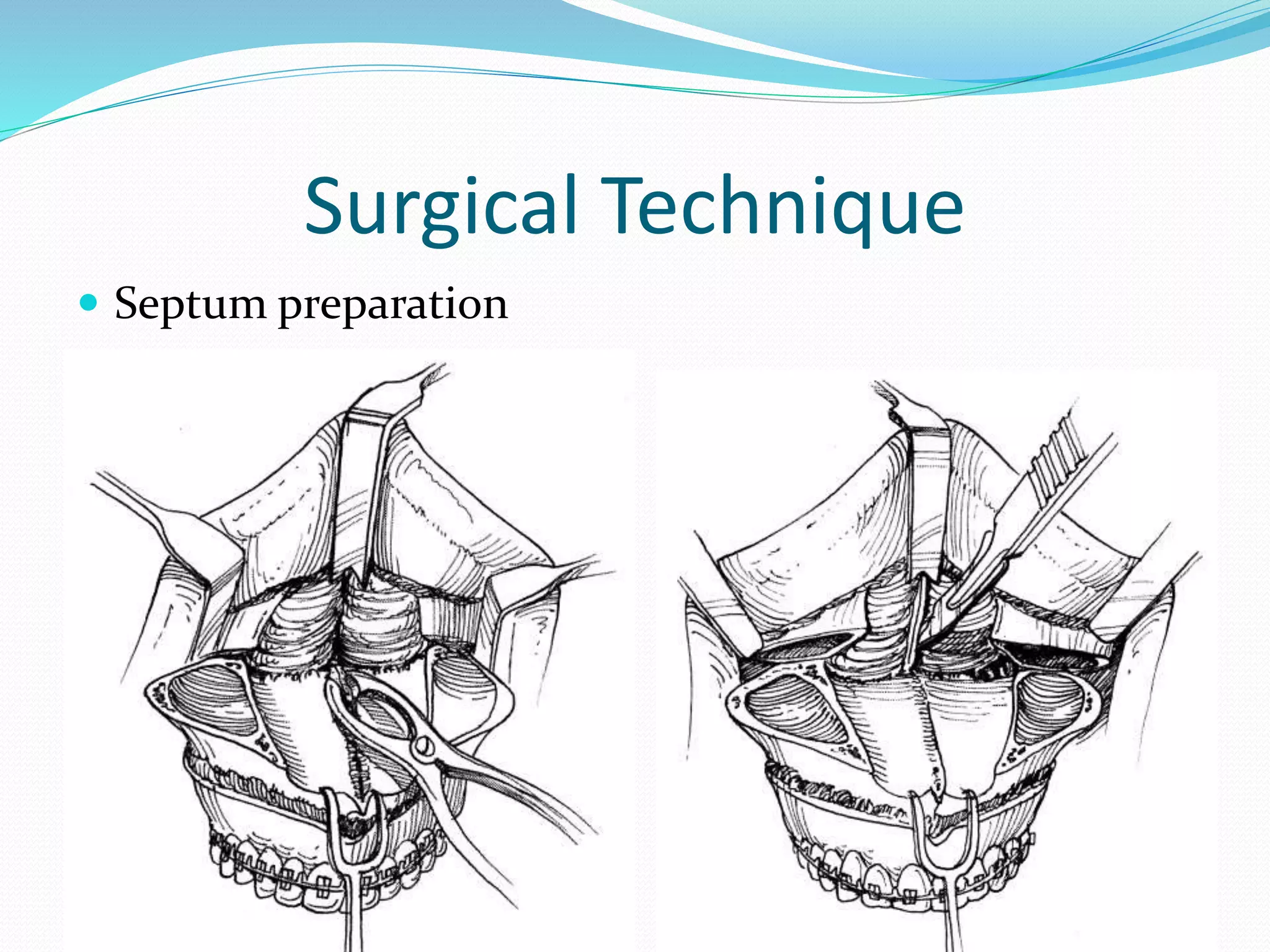 Maxillary surgery | PPT