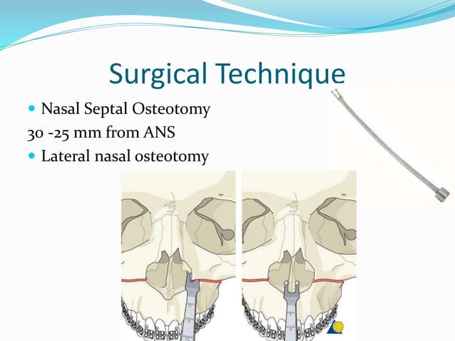 Maxillary surgery | PPT