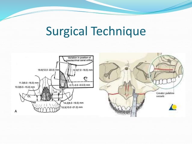 Maxillary surgery | PPT