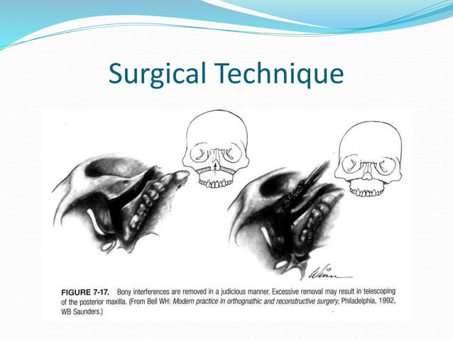 Maxillary surgery | PPT