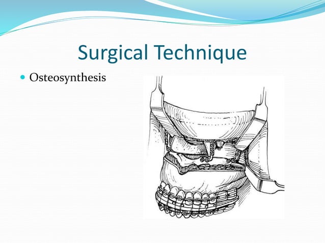 Maxillary surgery | PPT