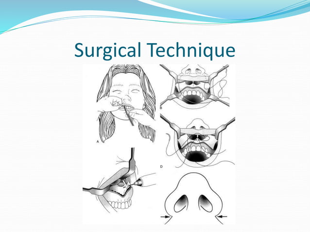 Maxillary surgery | PPT