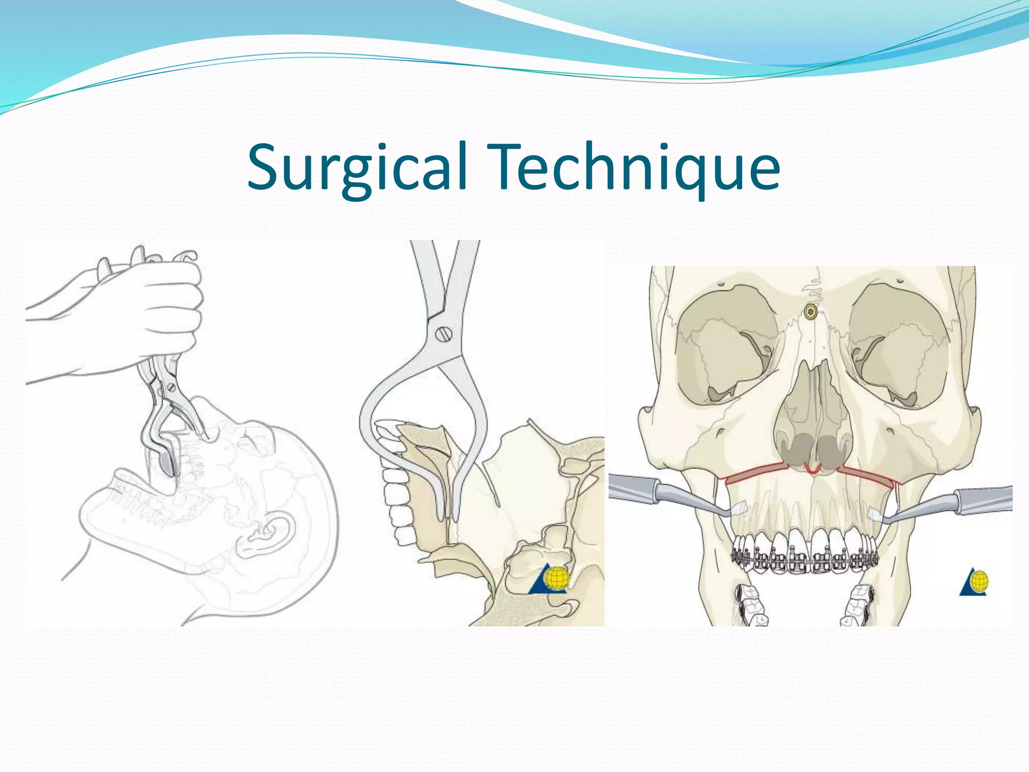 maxillary osteotomies | PPTX