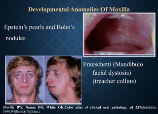 Maxilla | PPTX