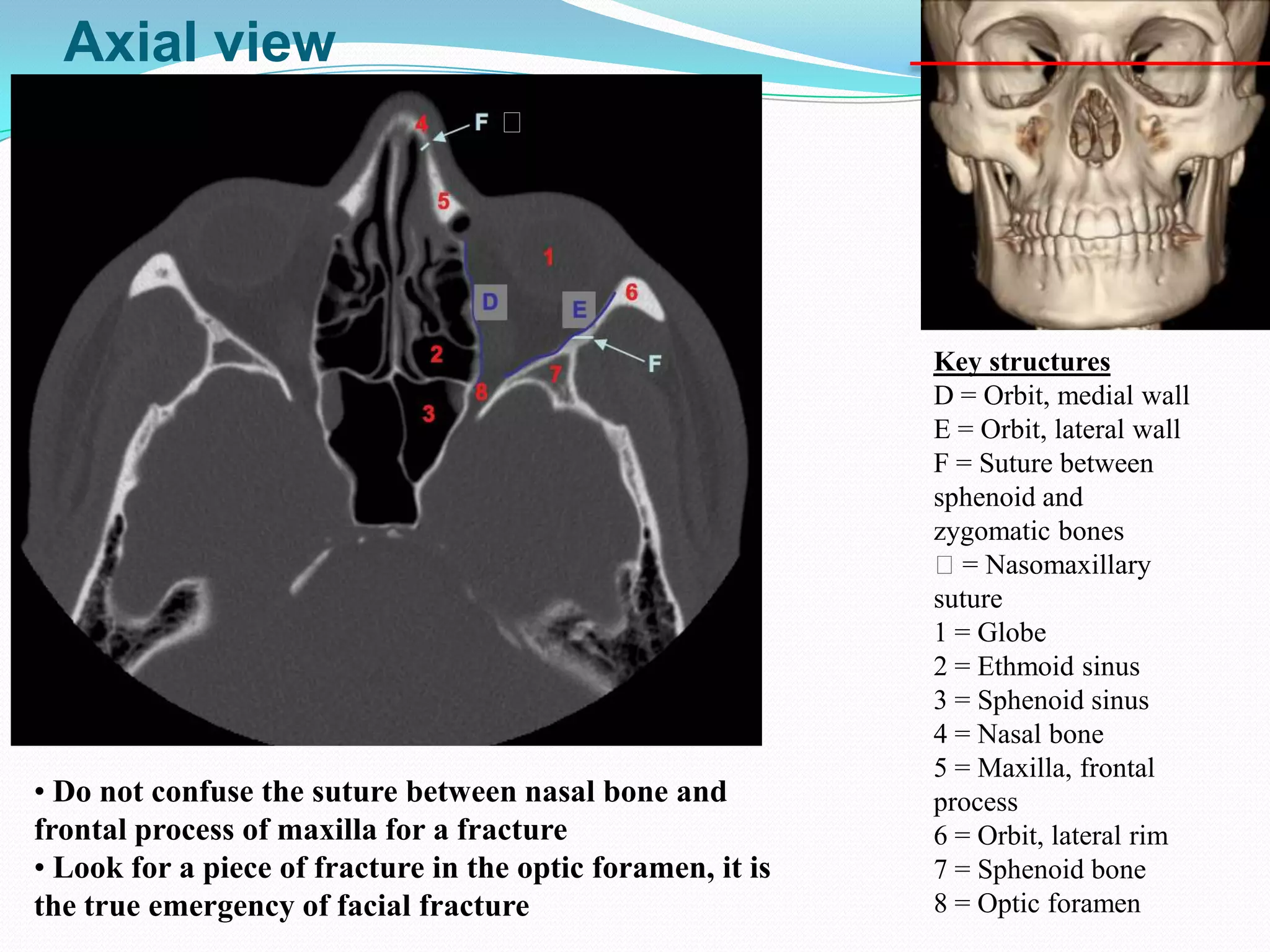 Maxilla anatomy, development & surgical anatomy | PPTX