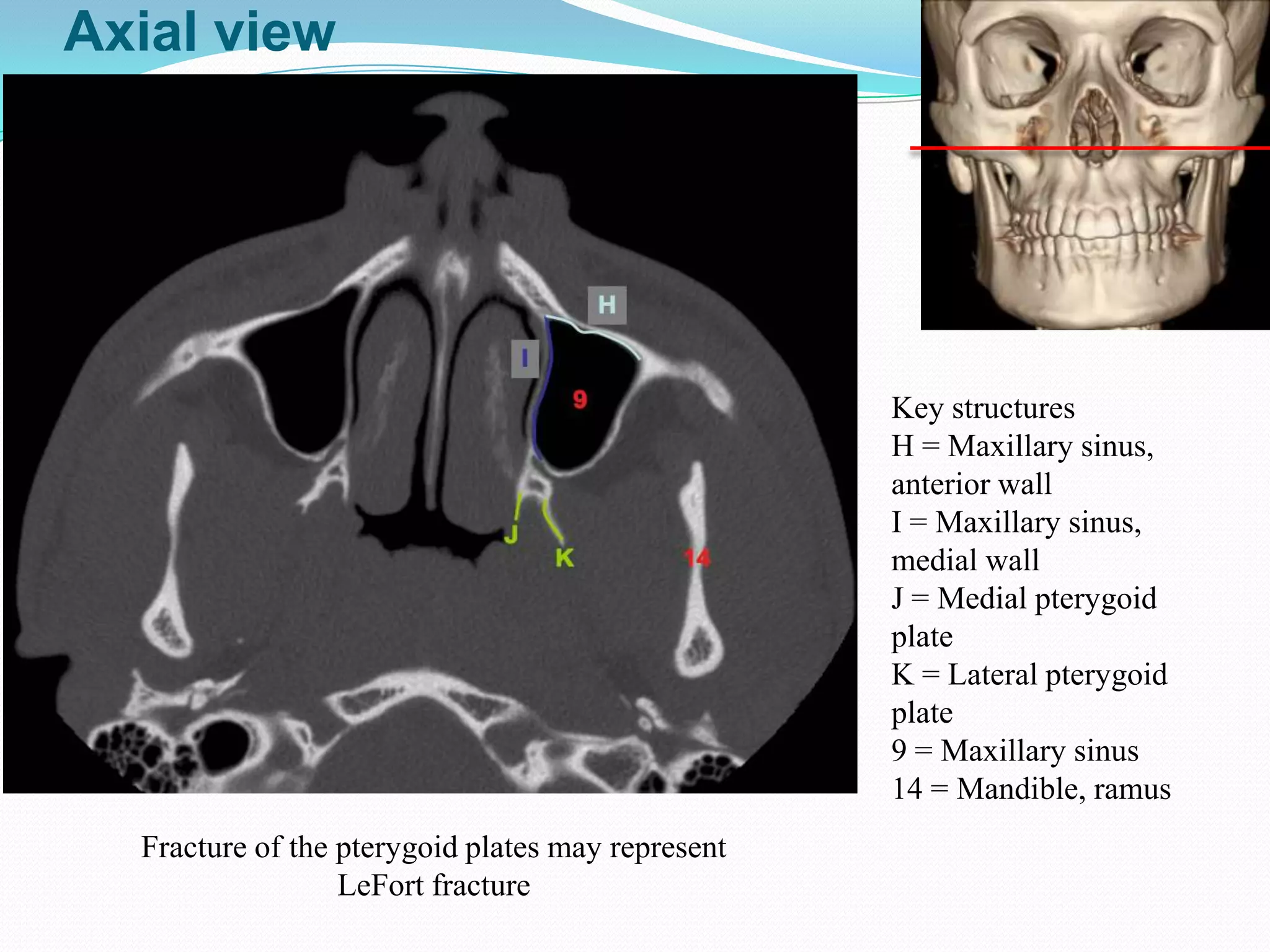 Maxilla anatomy, development & surgical anatomy | PPTX