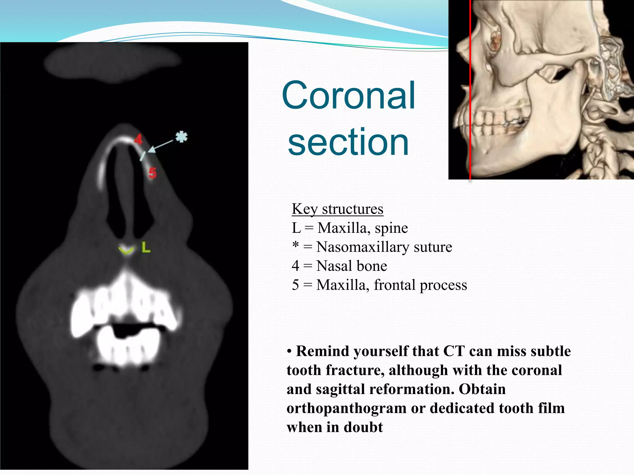 Maxilla anatomy, development & surgical anatomy | PPTX