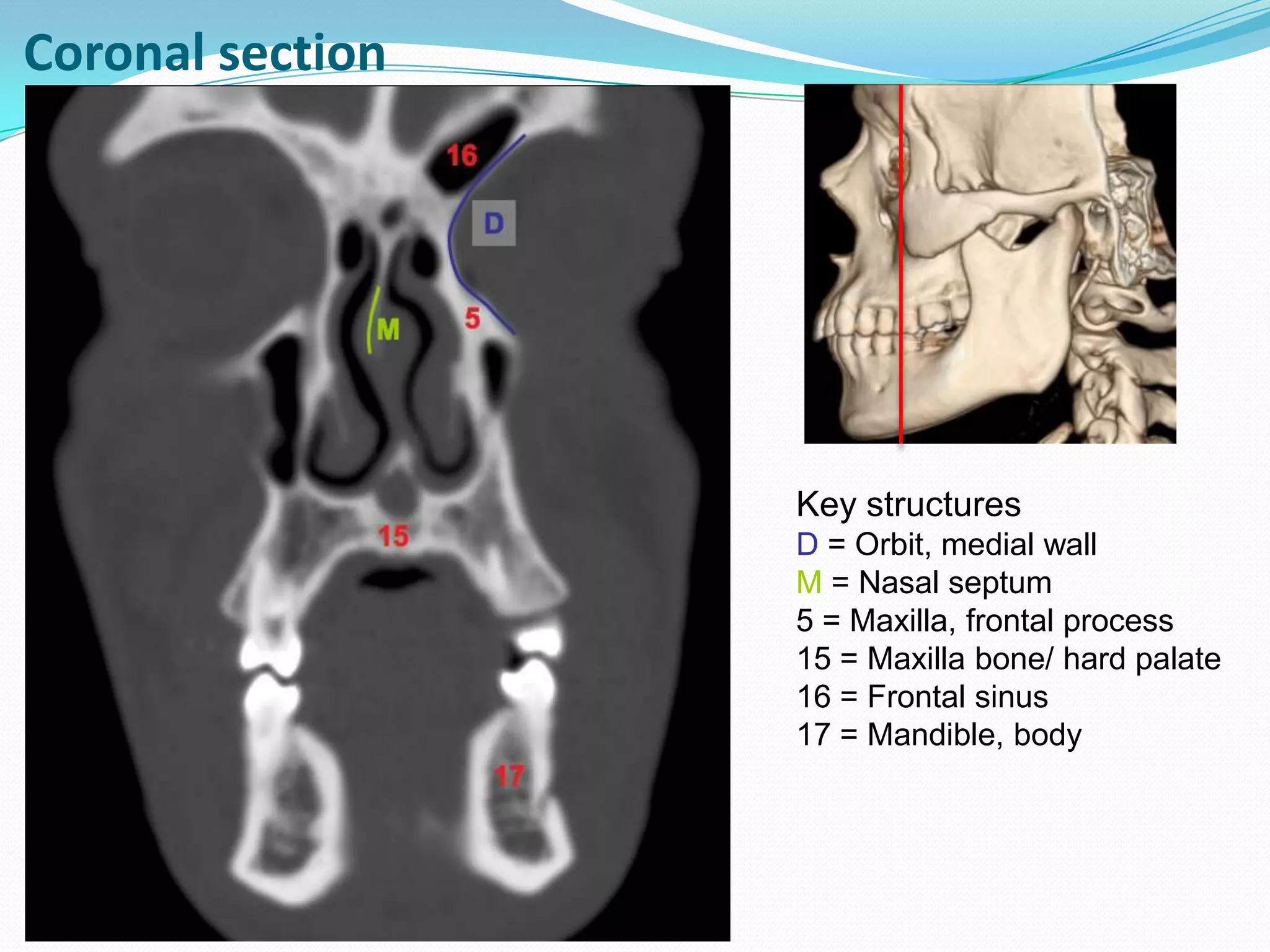 Maxilla anatomy, development & surgical anatomy | PPTX