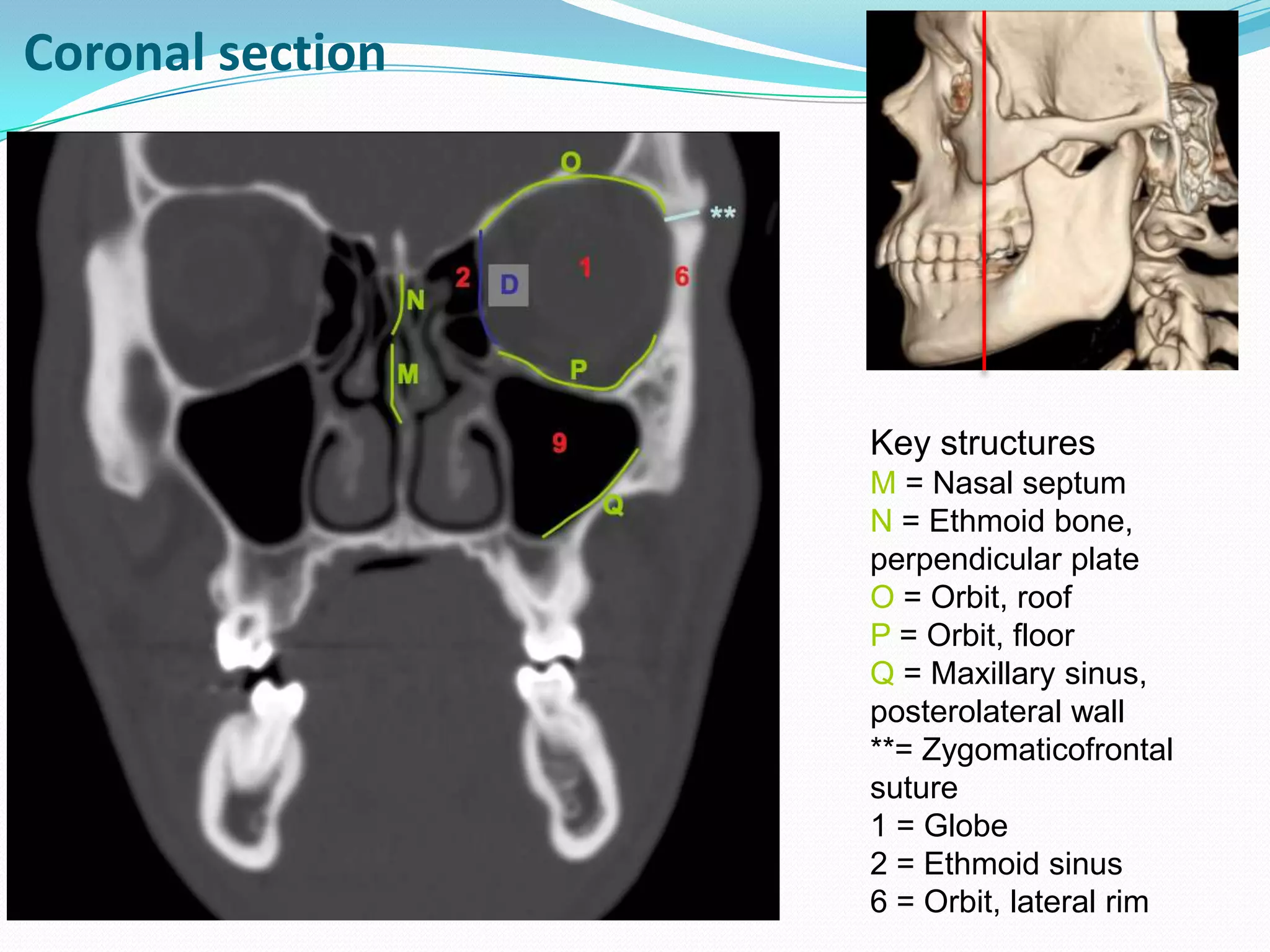 Maxilla anatomy, development & surgical anatomy | PPTX