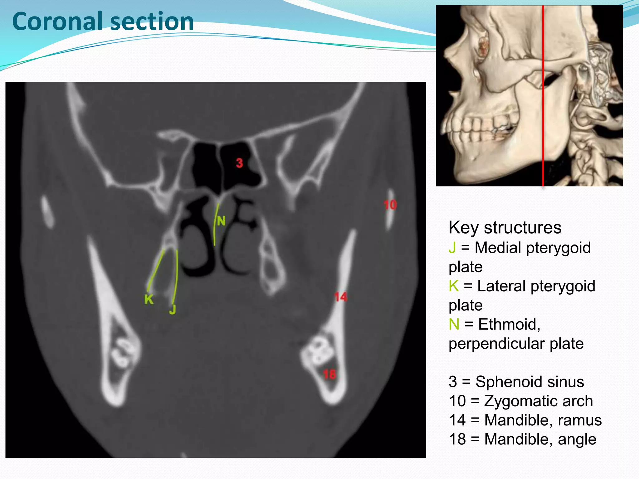 Maxilla anatomy, development & surgical anatomy | PPTX