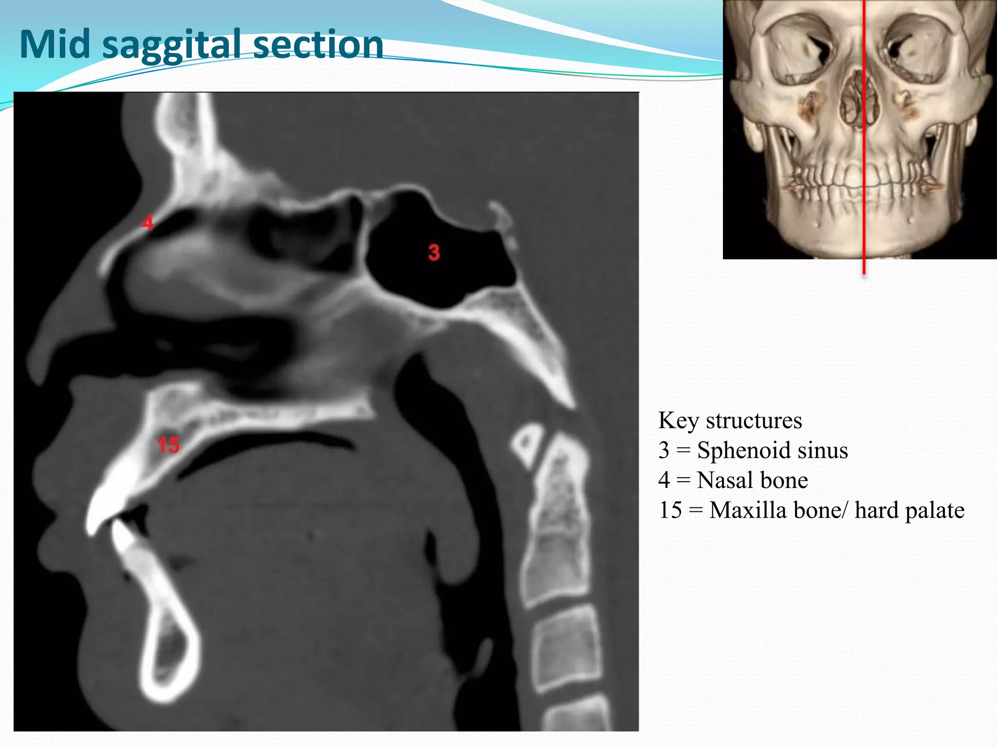 Maxilla anatomy, development & surgical anatomy | PPTX