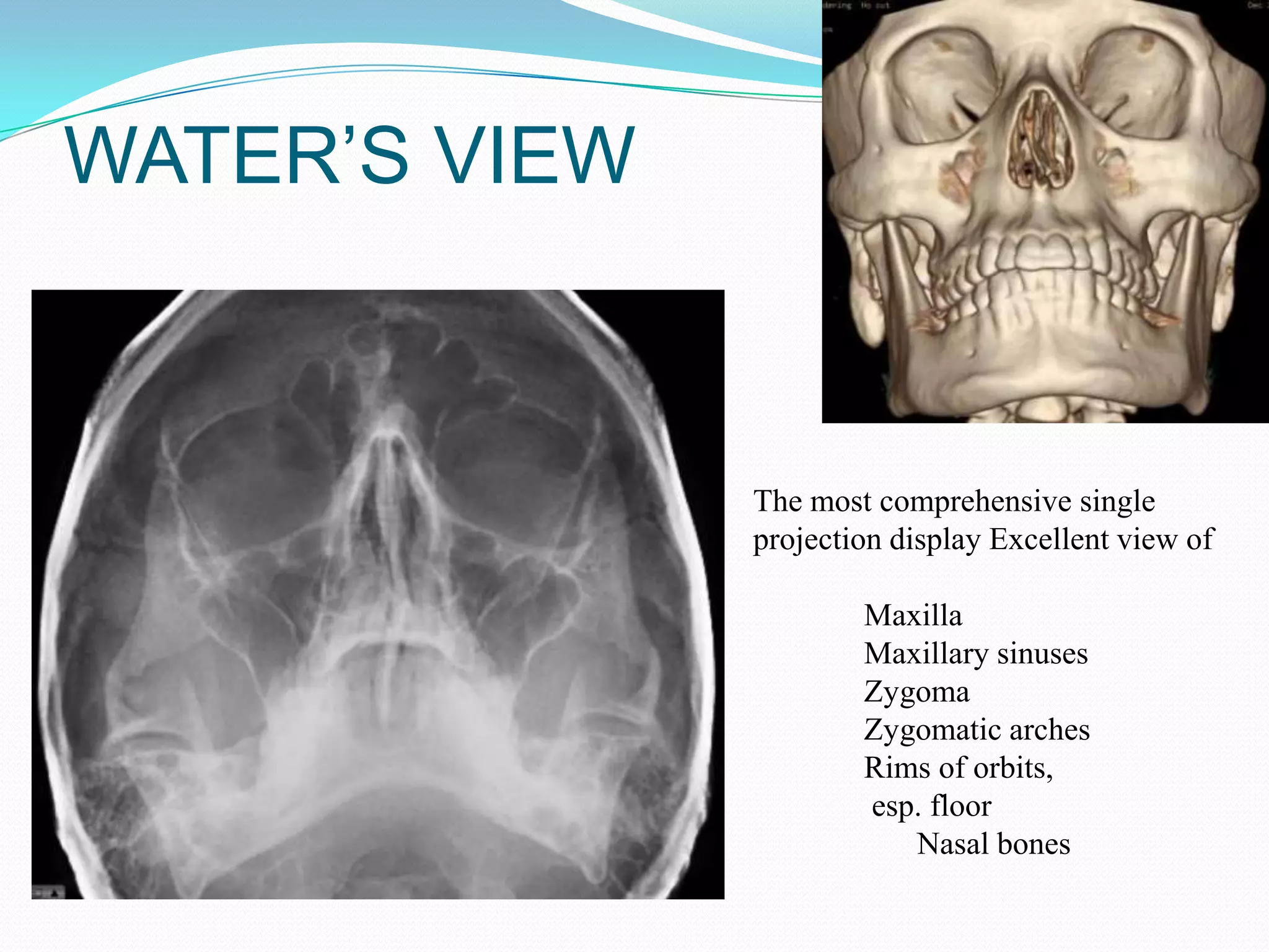 Maxilla anatomy, development & surgical anatomy | PPTX