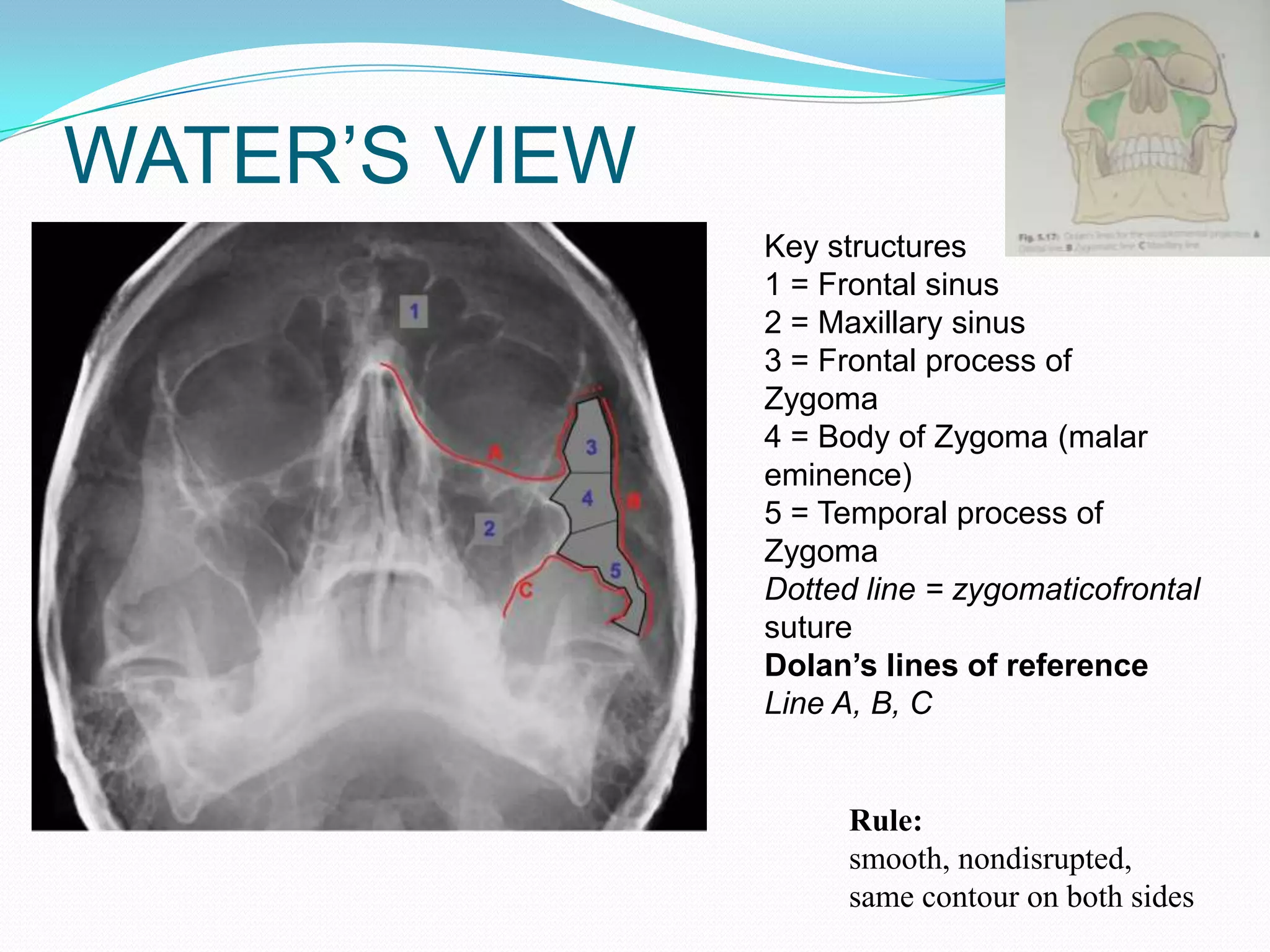 Maxilla anatomy, development & surgical anatomy | PPTX