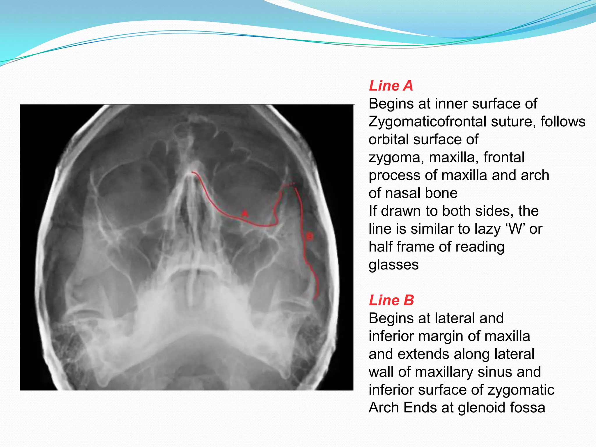 Maxilla anatomy, development & surgical anatomy | PPTX