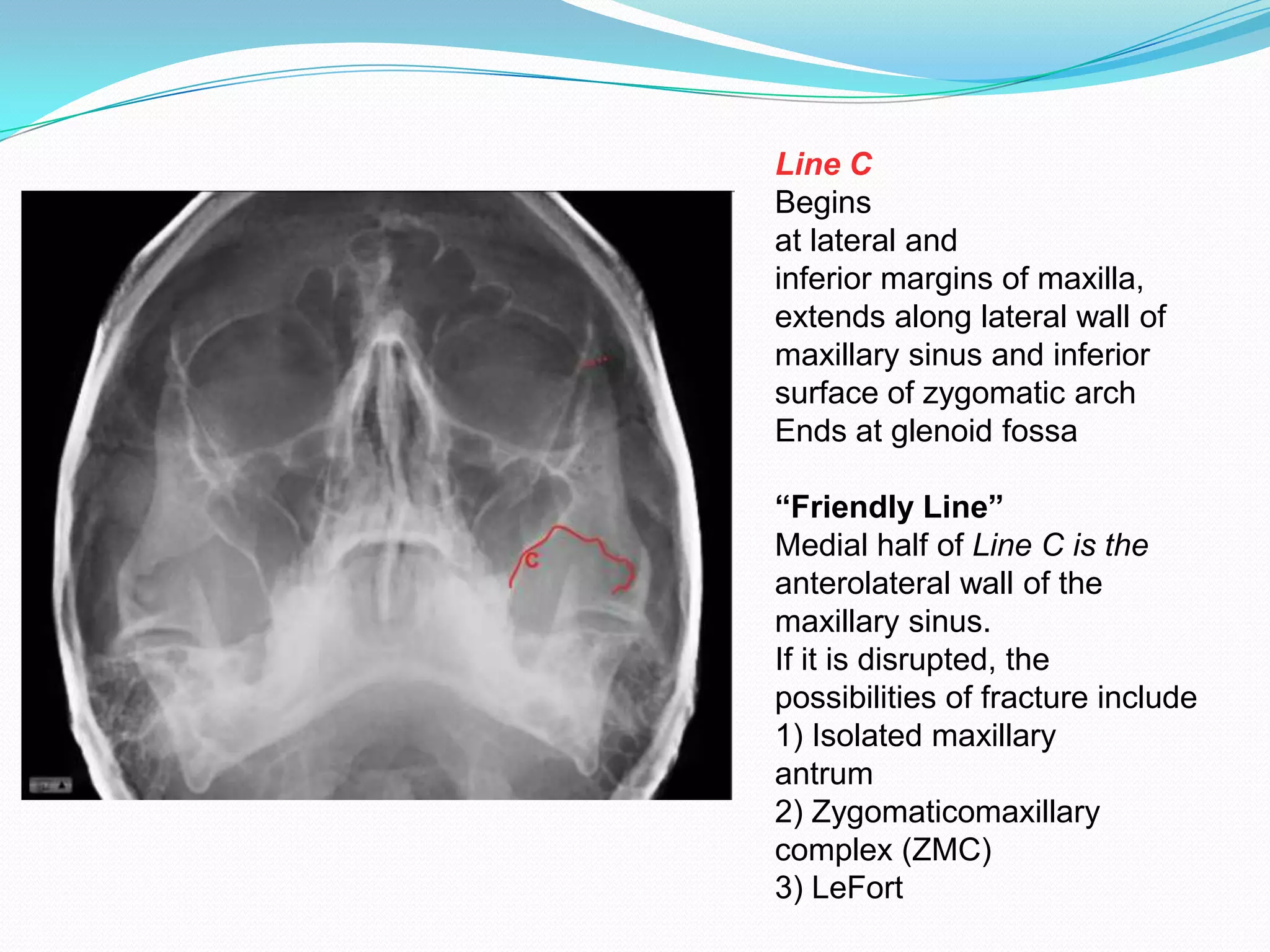 Maxilla anatomy, development & surgical anatomy | PPTX