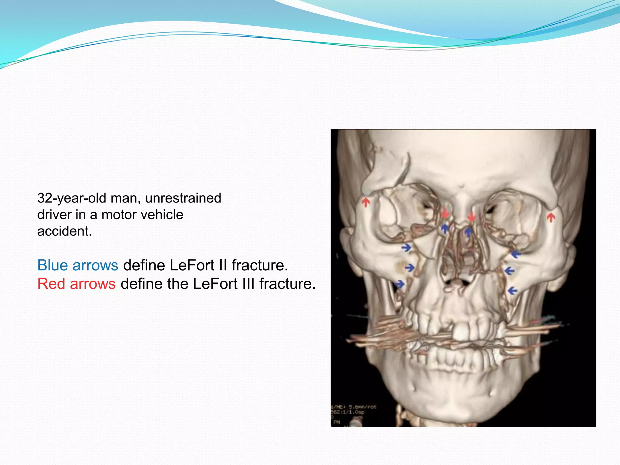 Maxilla anatomy, development & surgical anatomy | PPTX