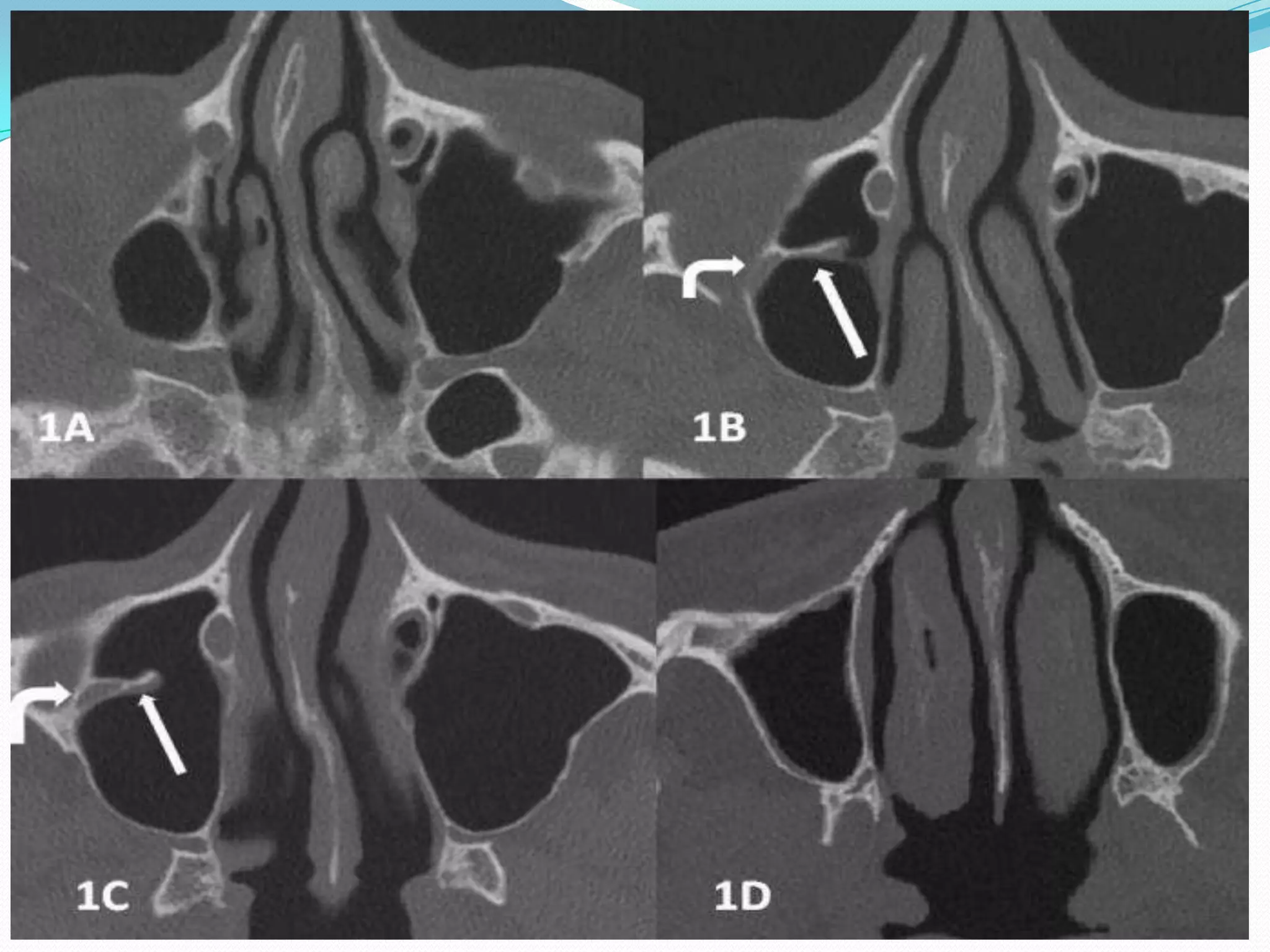 Maxilla anatomy, development & surgical anatomy | PPTX