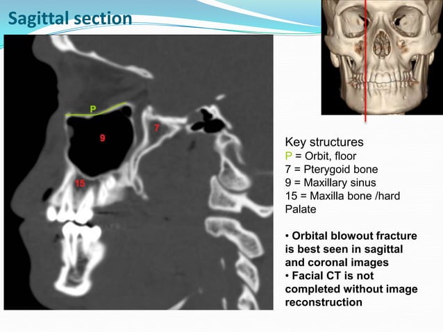 Maxilla anatomy, development & surgical anatomy | PPTX