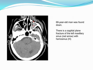 Maxilla anatomy, development & surgical anatomy | PPTX