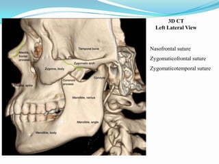 Nasomaxillary Suture