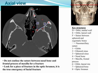 Frontal Process Maxilla 2