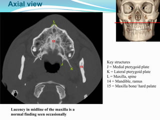 Palatal Process Of Maxilla