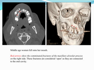 Alveolar Arch Of Maxilla