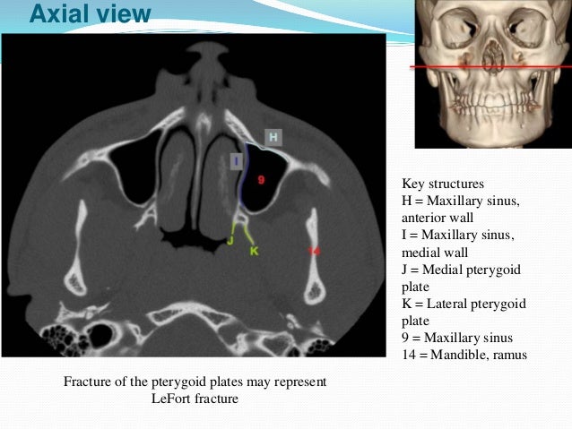 Maxilla anatomy, development & surgical anatomy