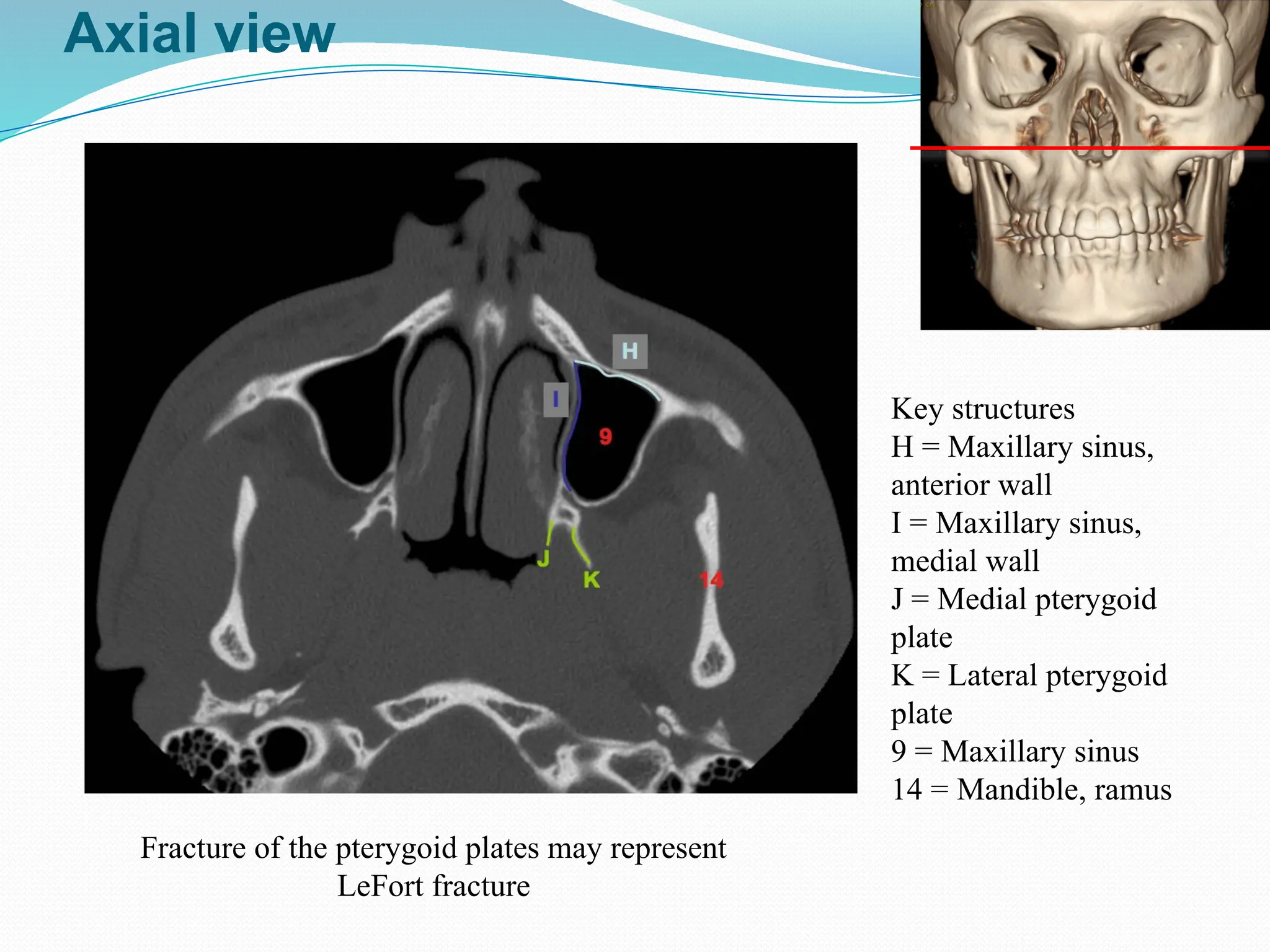 maxilla anatomy development surgical anatomy.pptx
