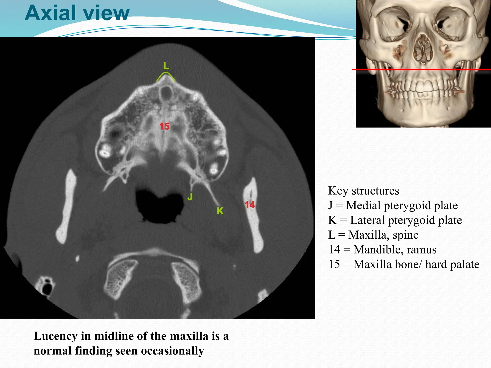 maxilla anatomy development surgical anatomy.pptx