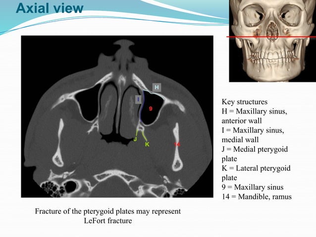 maxilla anatomy development surgical anatomy.pptx